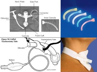 Tracheostomy | PPT