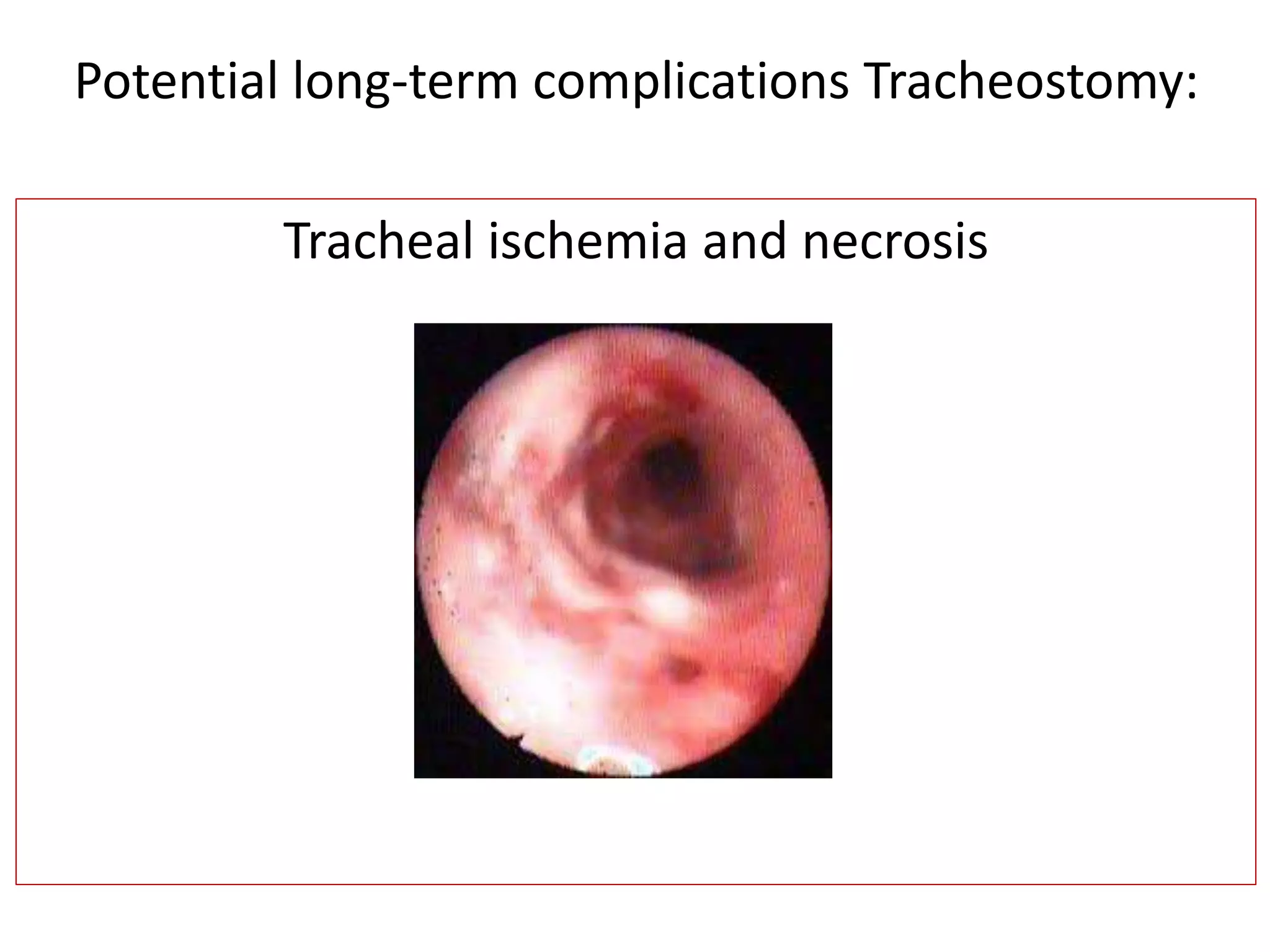Tracheostomy care | PPTX