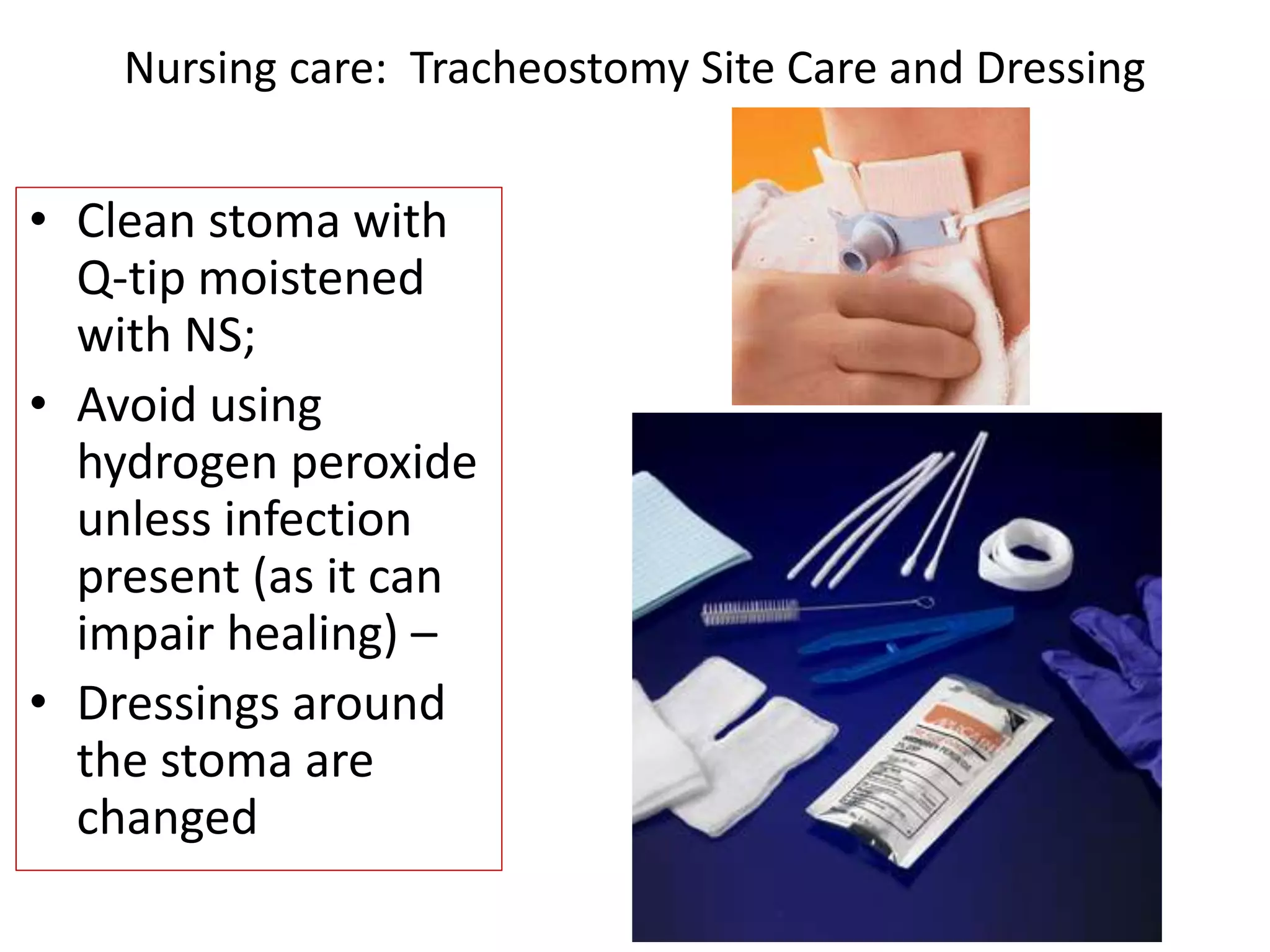 Tracheostomy care | PPTX