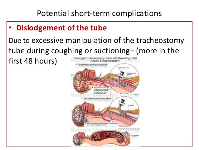 Tracheostomy care