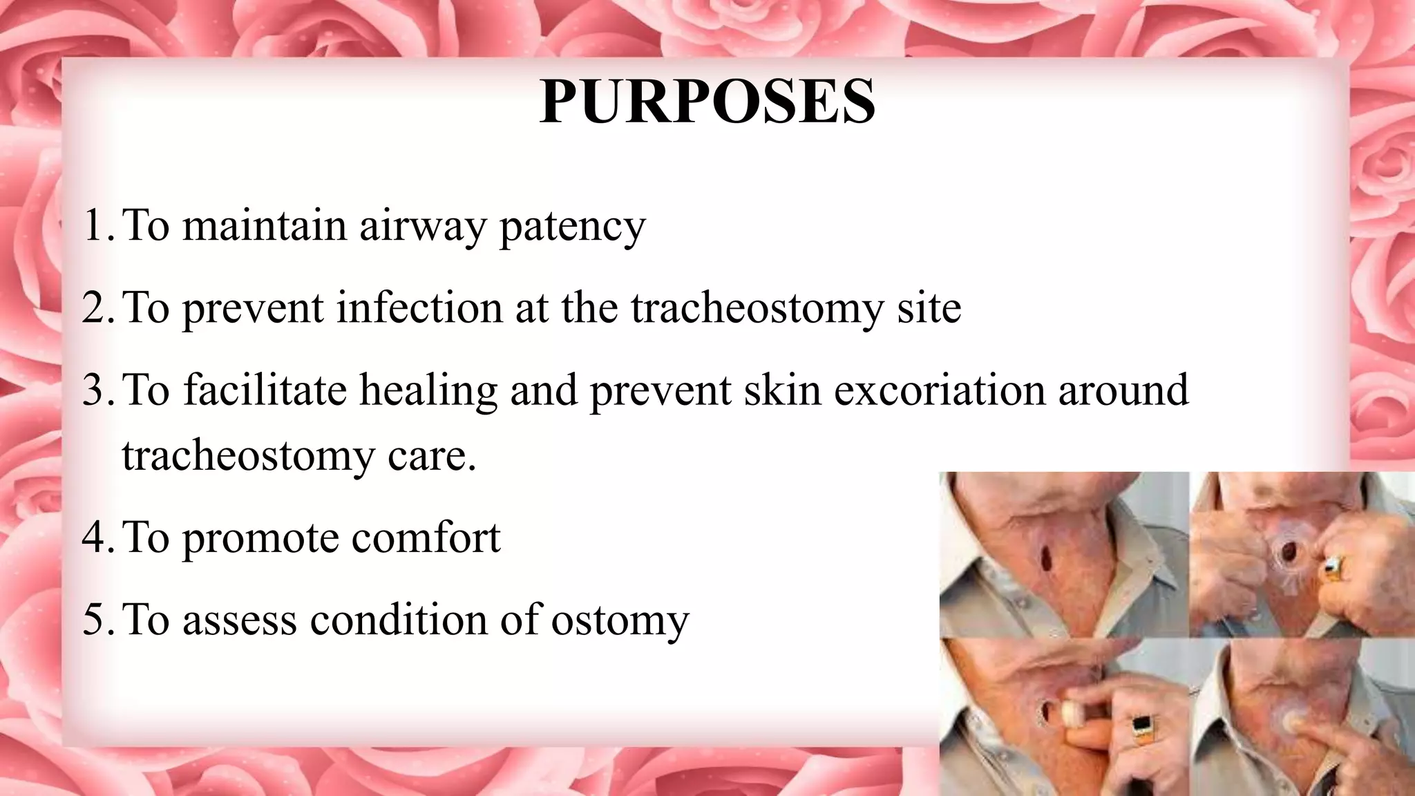 Tracheostomy care | PPTX