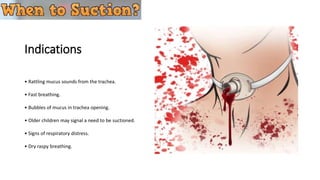 Tracheostomy care | PPTX