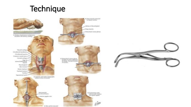 Tracheostomy Placement Diagram