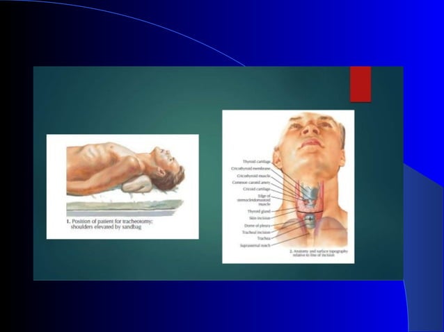 Tracheostomy and post op care | PPT | Ear, Nose and Throat Conditions ...