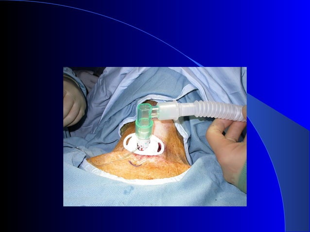 Tracheostomy and post op care | PPT | Ear, Nose and Throat Conditions ...