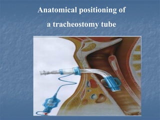 care of the patient with a Tracheostomy | PDF