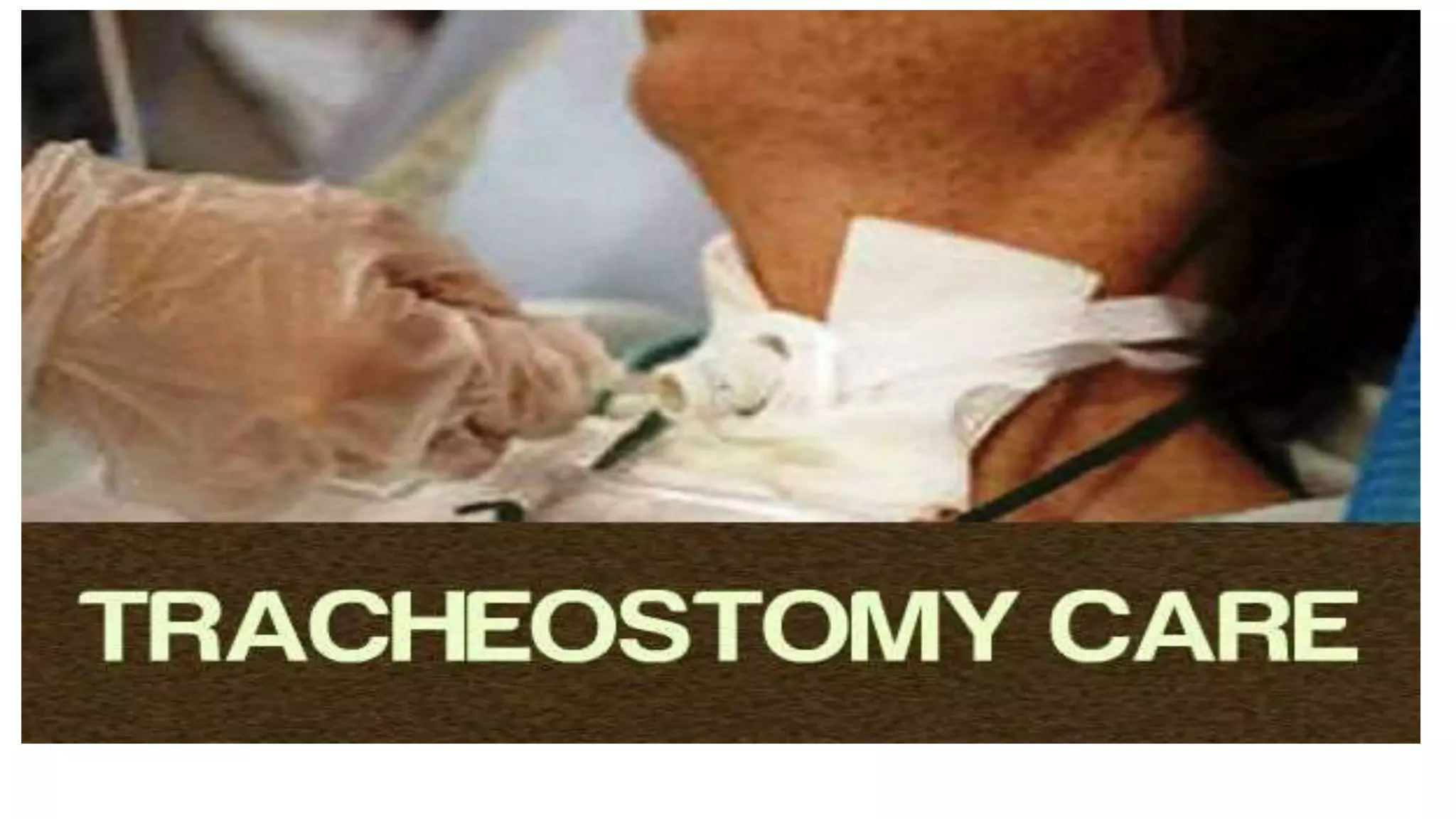 Tracheostomy care and management | PPTX
