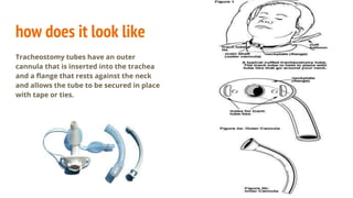 Tracheostomy care and management | PPTX