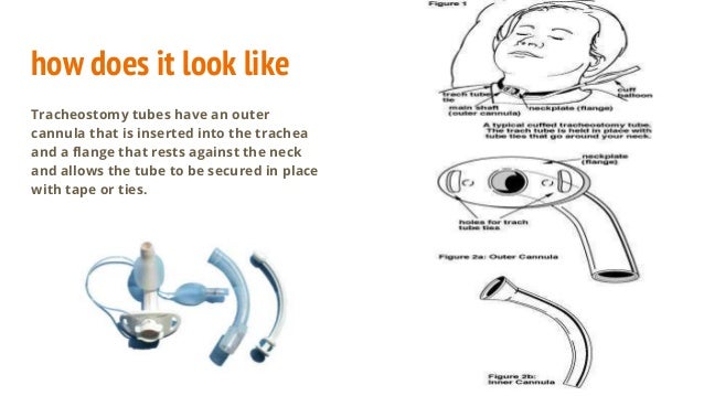 Tracheostomy care and management