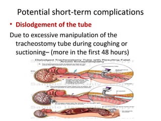 Tracheostomycarebitto 131204115039-phpapp01 | PPT
