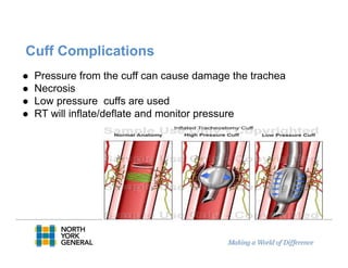 Tracheostomy care & management | PDF