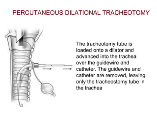 Tracheostomy class | PPTX