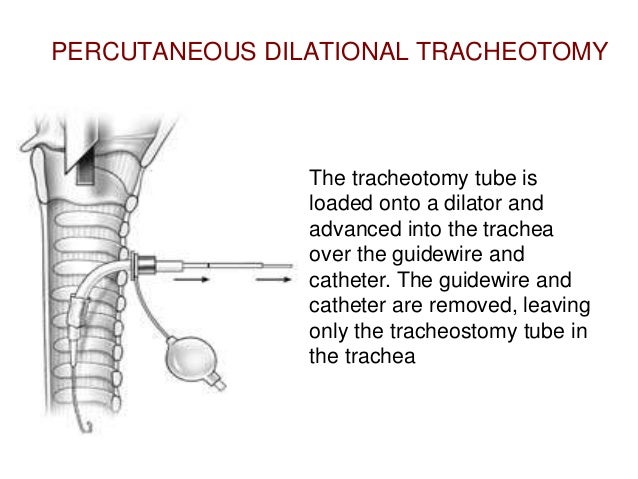 Tracheostomy Placement Diagram