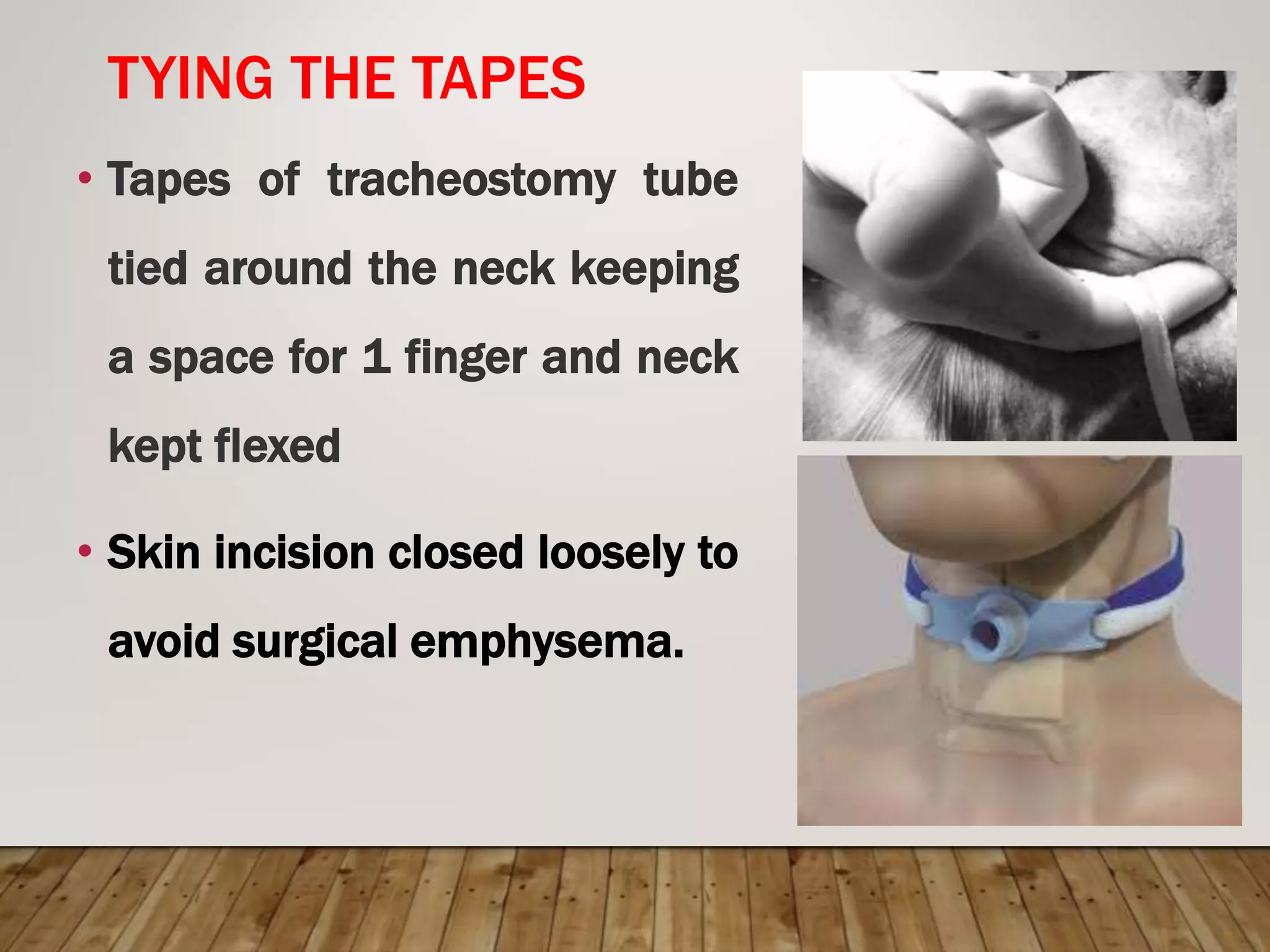 Tracheostomy( dr. krishna prasad koirala) | PPT