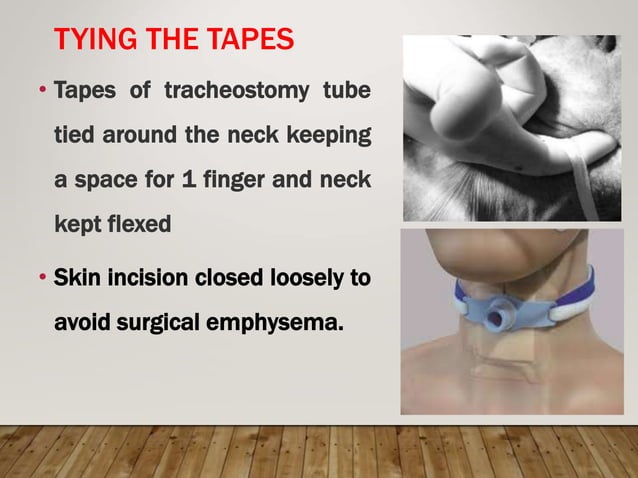 Tracheostomy( dr. krishna prasad koirala) | PPT | Death, Injury, or ...