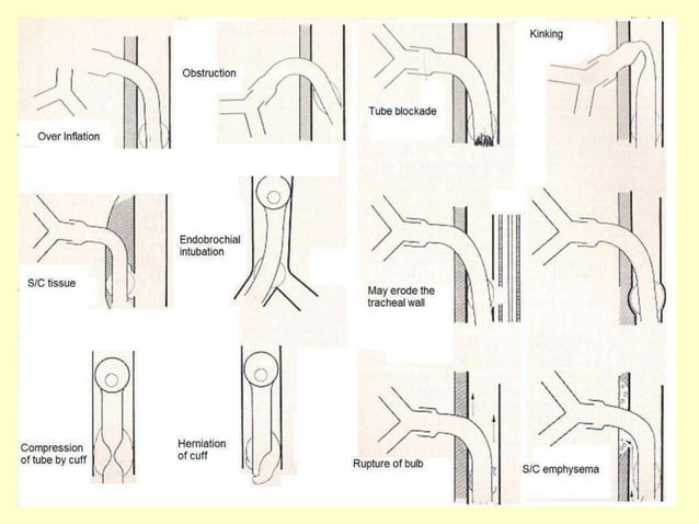 Tracheostomy for PG students | PPT