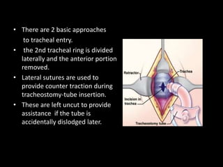 Tracheostomy final | PPTX