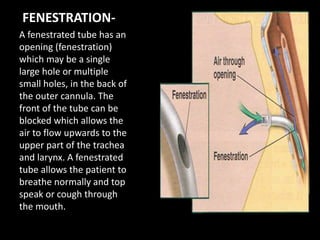 Tracheostomy final | PPTX