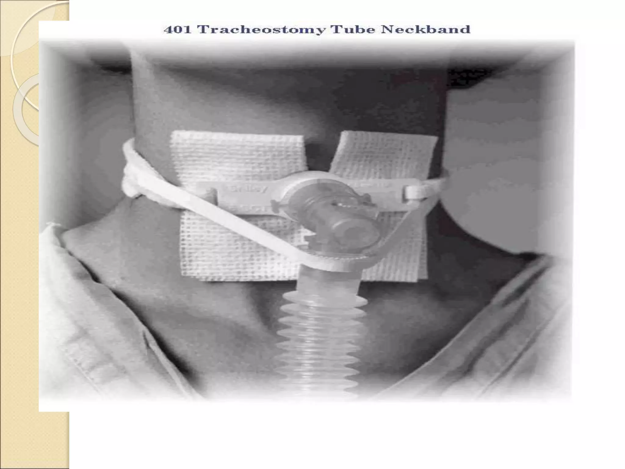 Tracheostomy | PPT
