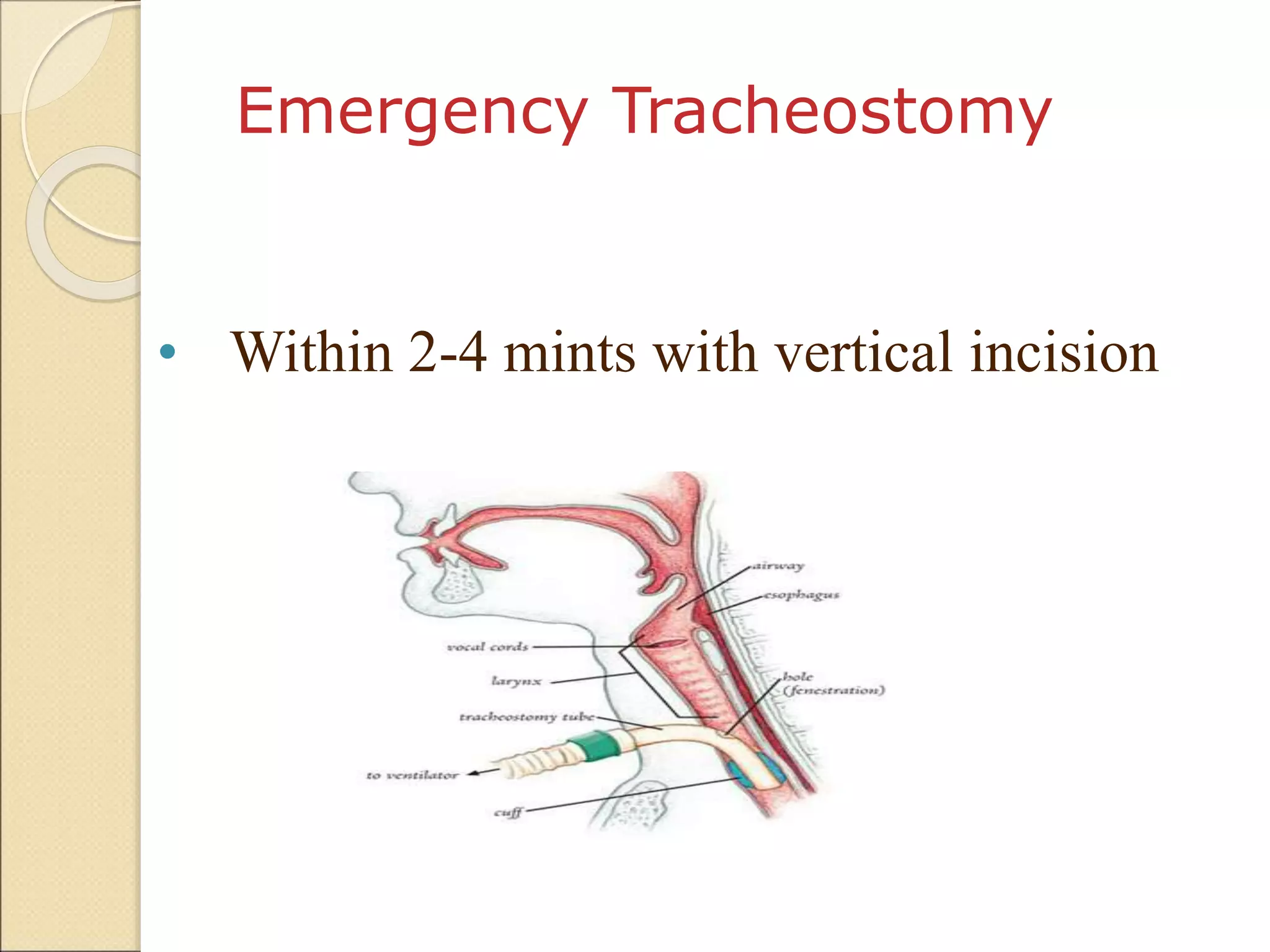 Tracheostomy | PPT