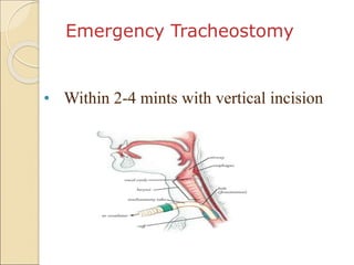 Emergency Tracheostomy Procedure