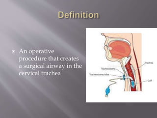 Tracheostomy Final.pptx