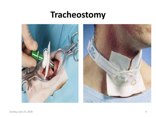 Tracheostomy and its care | PPTX