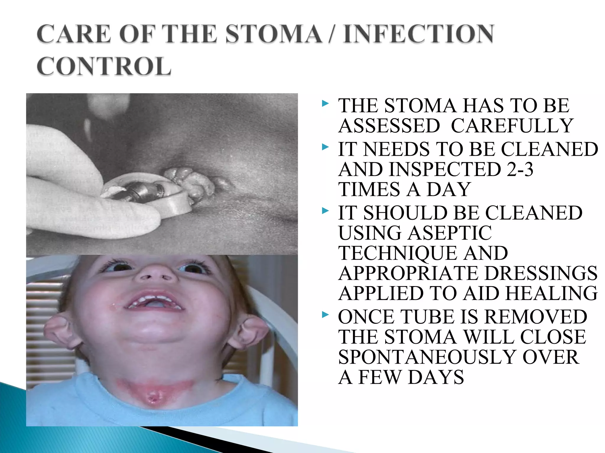 Tracheostomy john | PPT