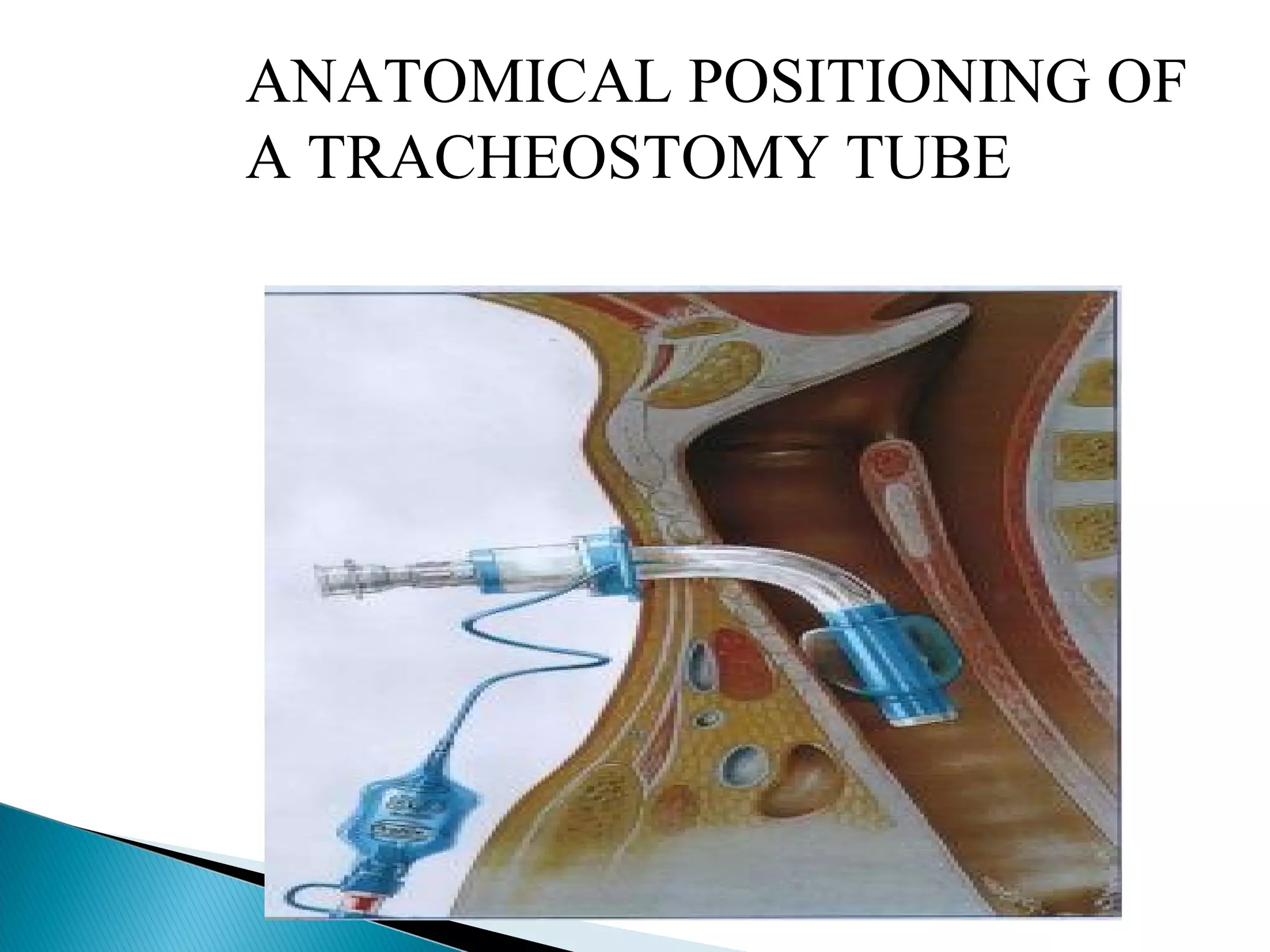 Tracheostomy john | PPT