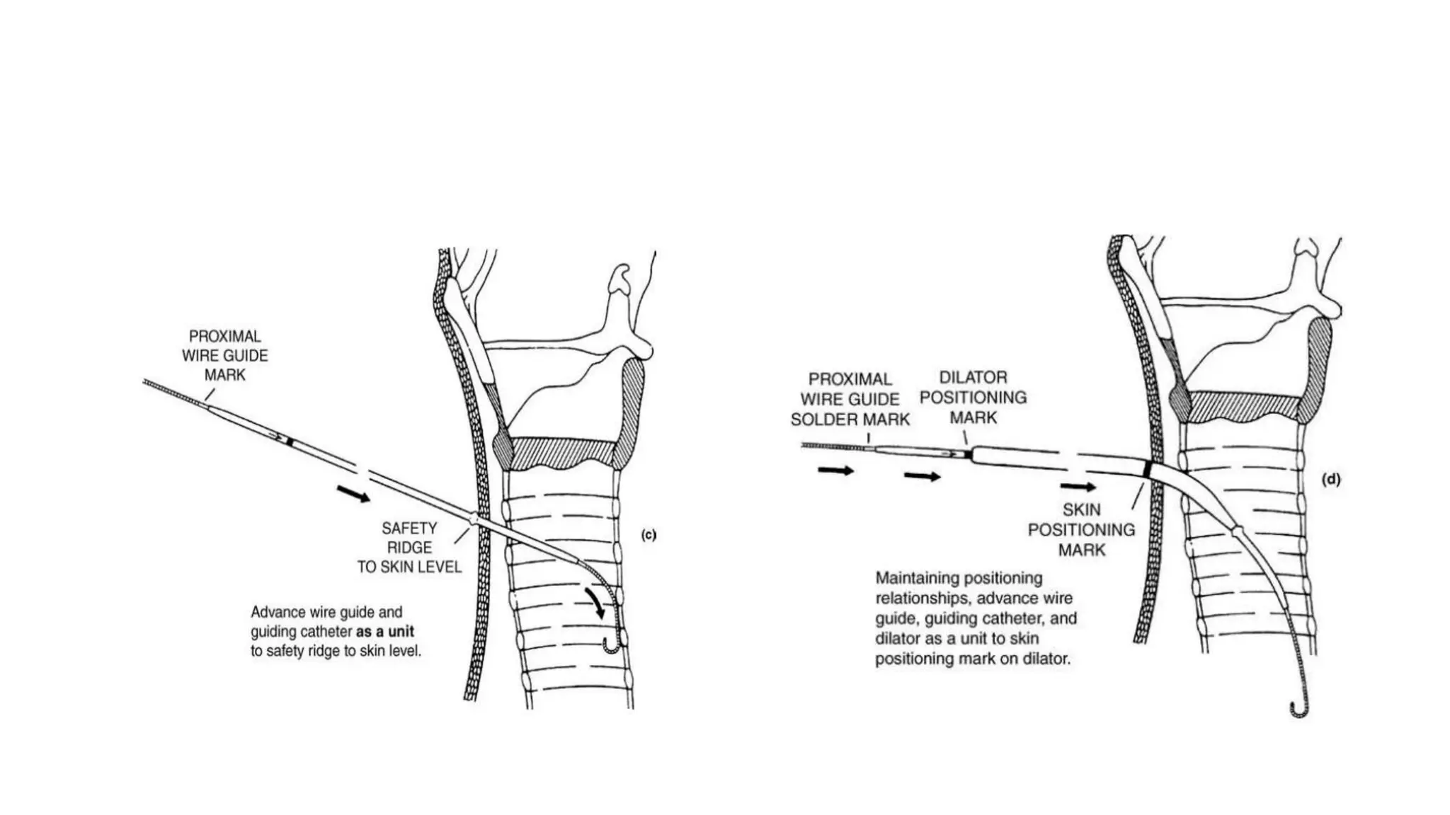 Tracheostomy | PPTX