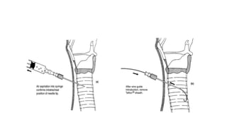 Tracheostomy | PPTX