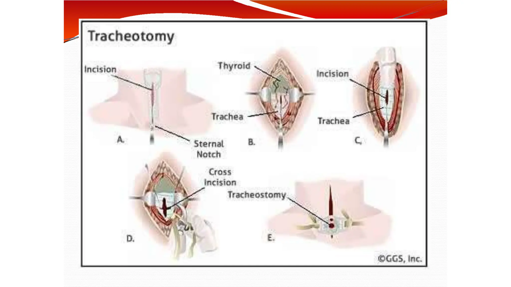 tracheostomy new.pptx by professor Dr Ahmed Al Abbasi | PPTX