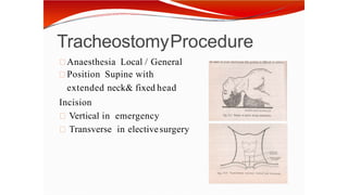 tracheostomy new.pptx by professor Dr Ahmed Al Abbasi | PPTX
