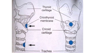 tracheostomy new (2).power point presentation | PPTX