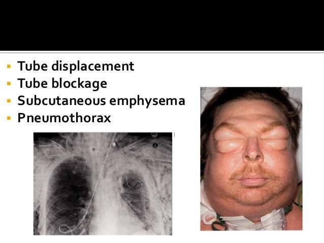Tracheostomy ppt