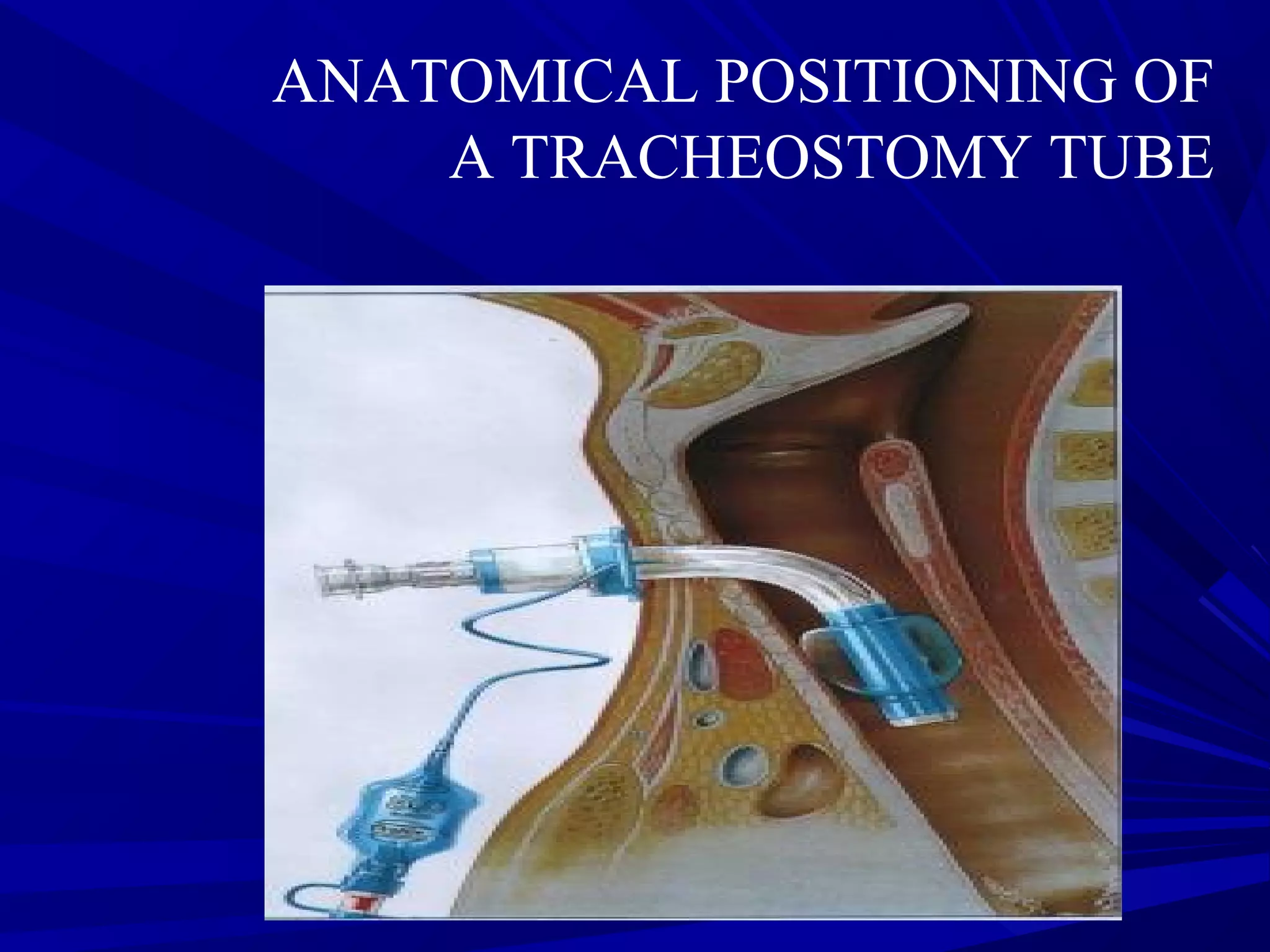 Tracheostomy presentation | PPT