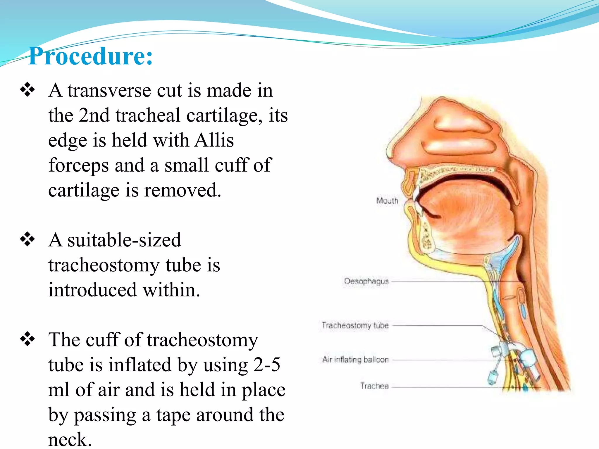 TRACHEOSTOMY SEMINAR.pptx