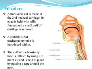 TRACHEOSTOMY SEMINAR.pptx