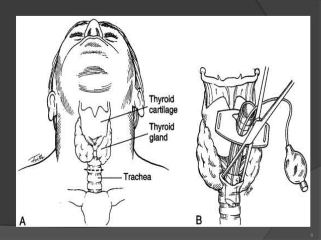 Tracheostomy site care procedure | PPTX | First Aid | Injuries