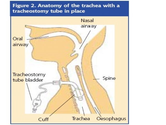 Tracheostomy suctioning