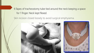 Tracheostomy & tracheal surgeries | PPTX
