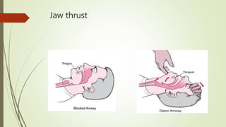 Tracheostomy & tracheal surgeries | PPTX