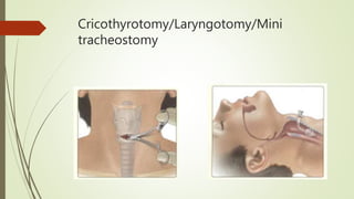 Tracheostomy & tracheal surgeries | PPTX