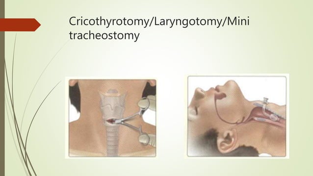 Tracheostomy & tracheal surgeries | PPT