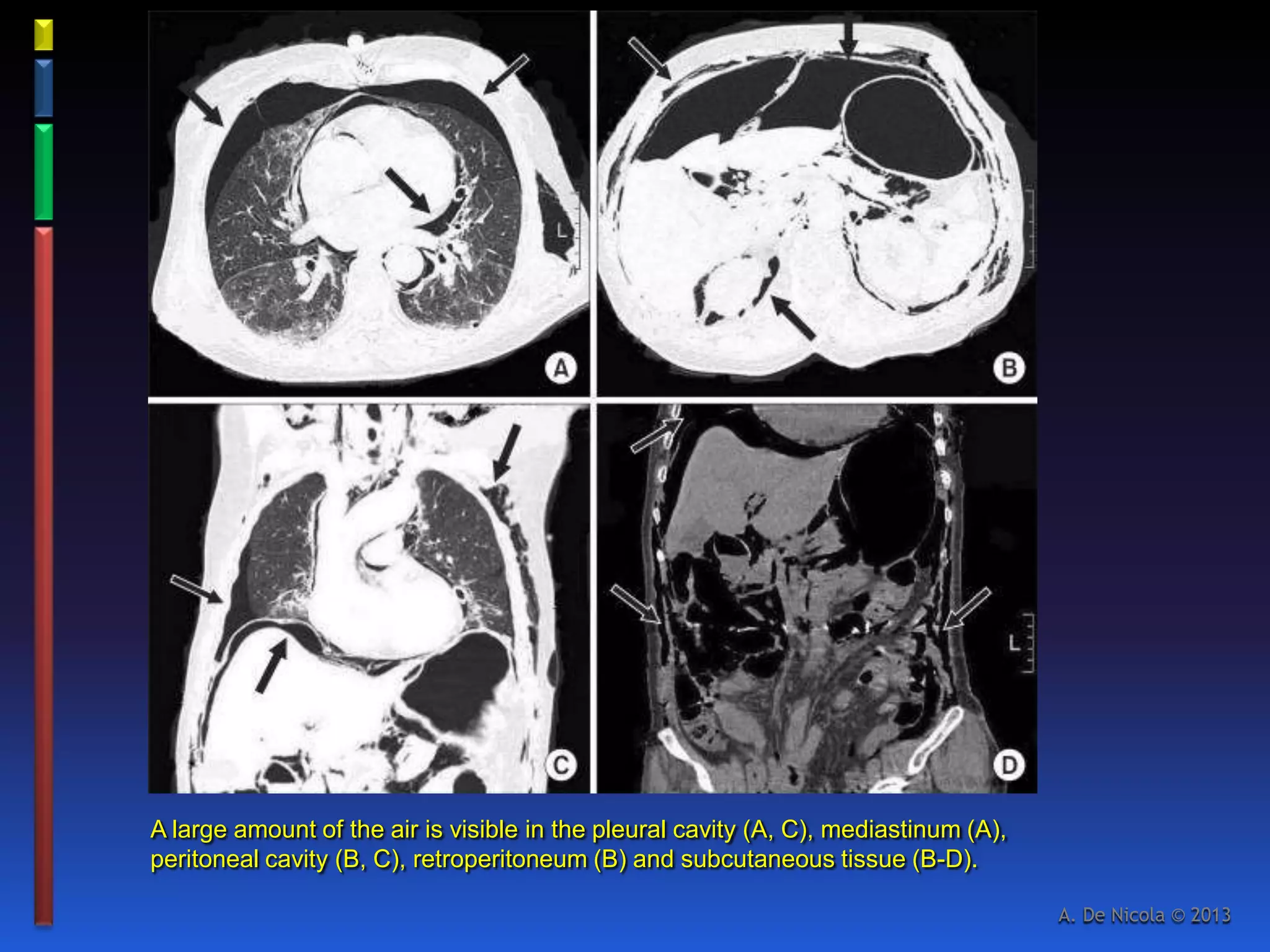 Tracheotomia percutanea con la tecnica Blue Dolphin | PPTX