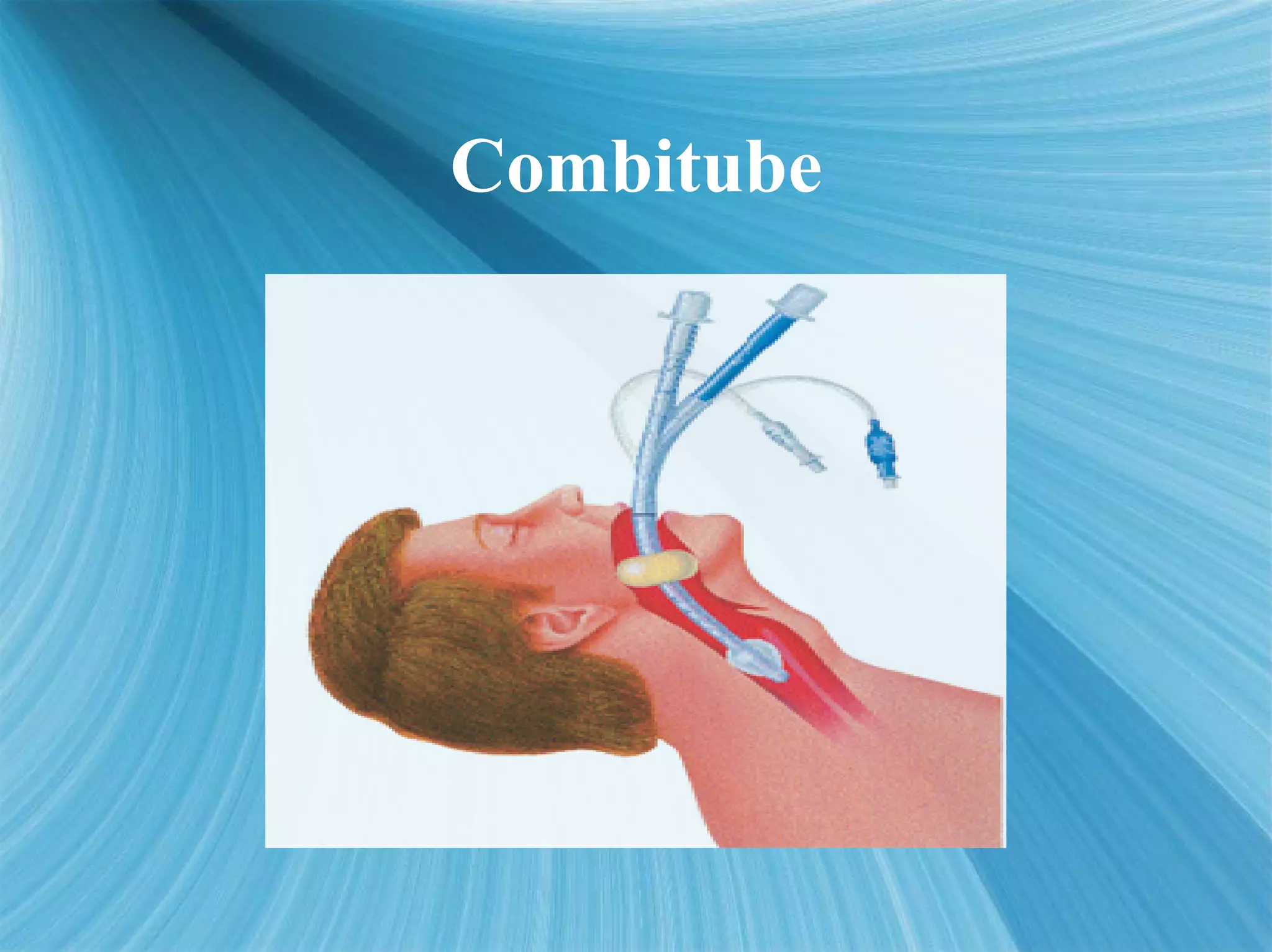 Tracheotomy - UCLA Head and Neck Surgery, ENT Ear, Nose & Throat ...