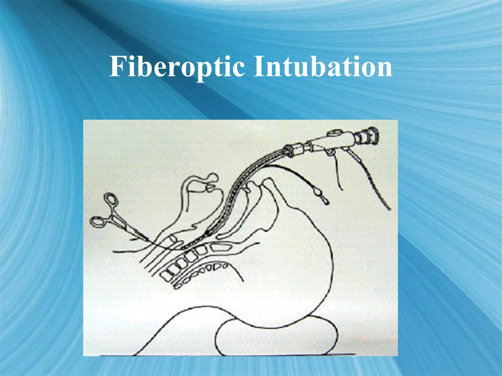 Tracheotomy - UCLA Head and Neck Surgery, ENT Ear, Nose & Throat ...