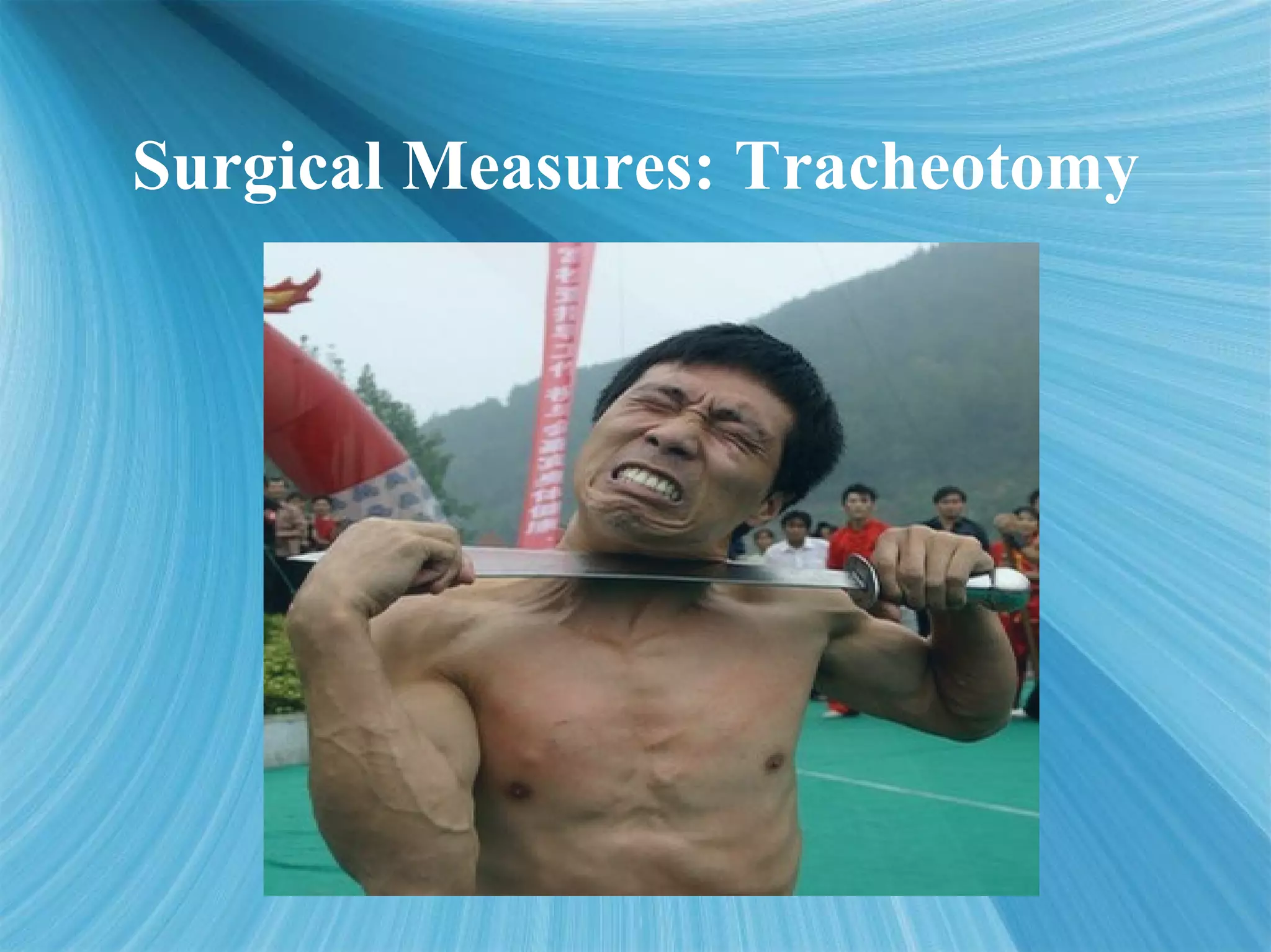 Tracheotomy - UCLA Head and Neck Surgery, ENT Ear, Nose & Throat ...