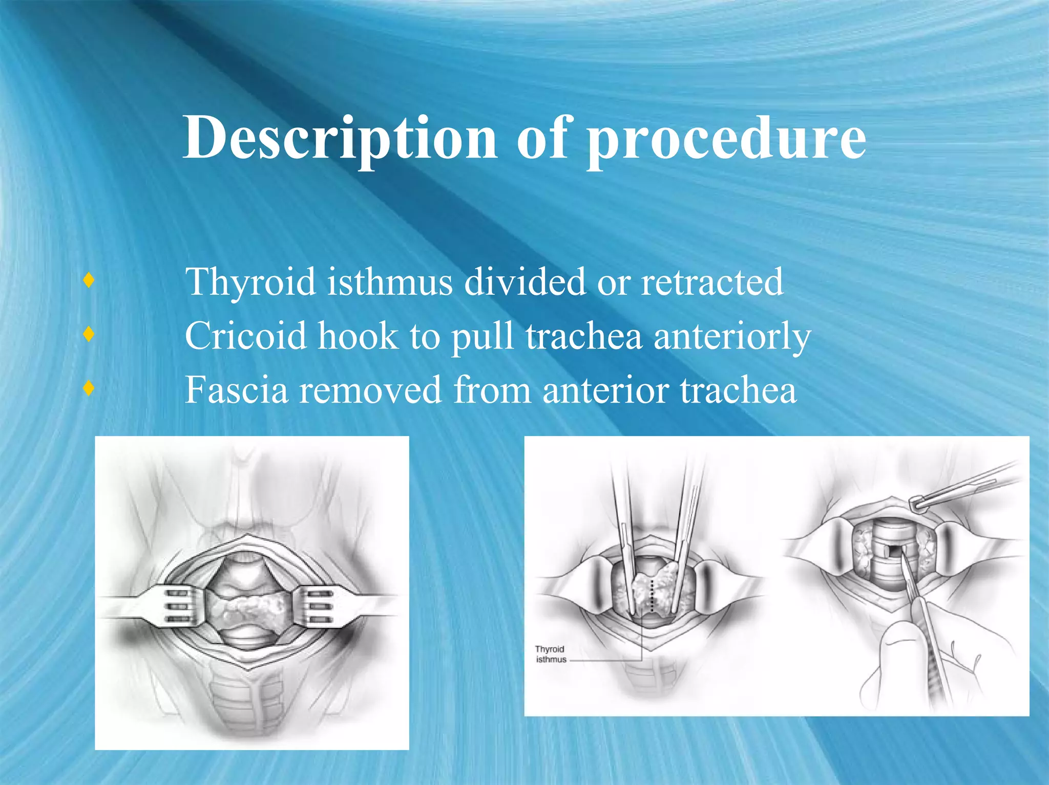Tracheotomy - UCLA Head and Neck Surgery, ENT Ear, Nose & Throat ...