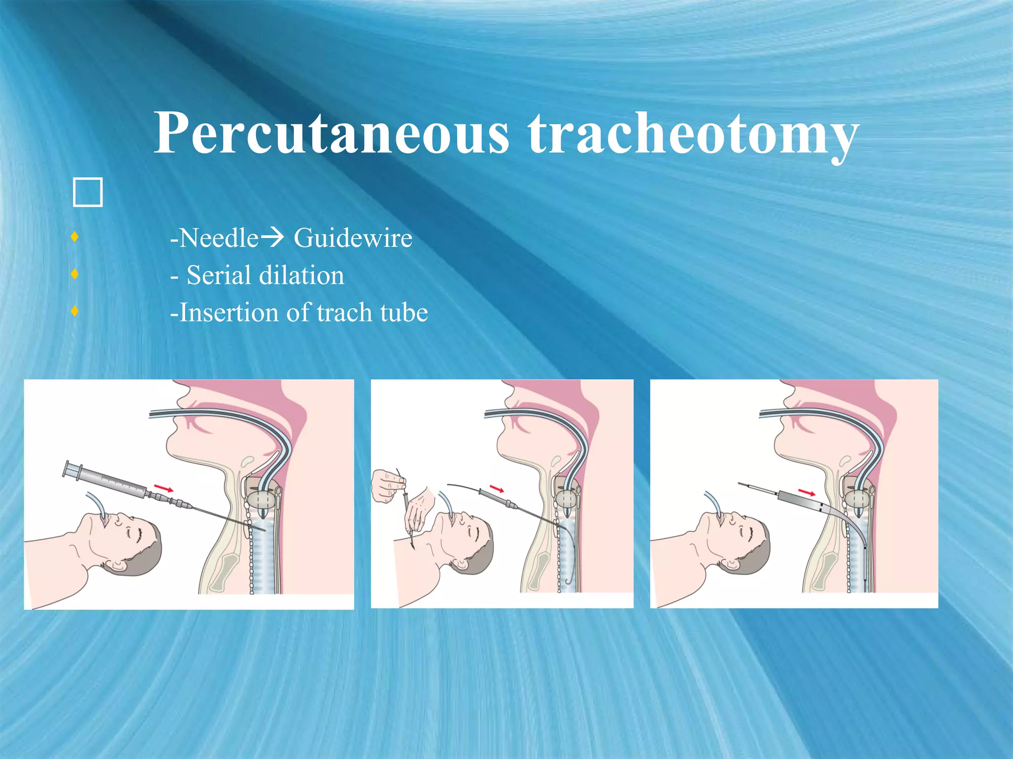 Tracheotomy - UCLA Head and Neck Surgery, ENT Ear, Nose & Throat ...